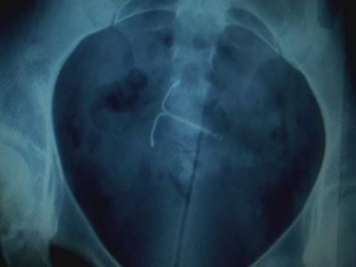 IUD Complications: Can I File a Lawsuit? - Kershaw Talley Barlow